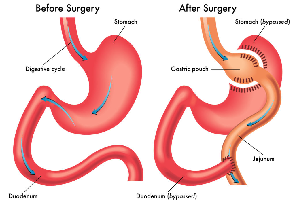 Bariatric Surgery Simple And Practical Mental Health Bariatric Surgery Simple And Practical Mental Health